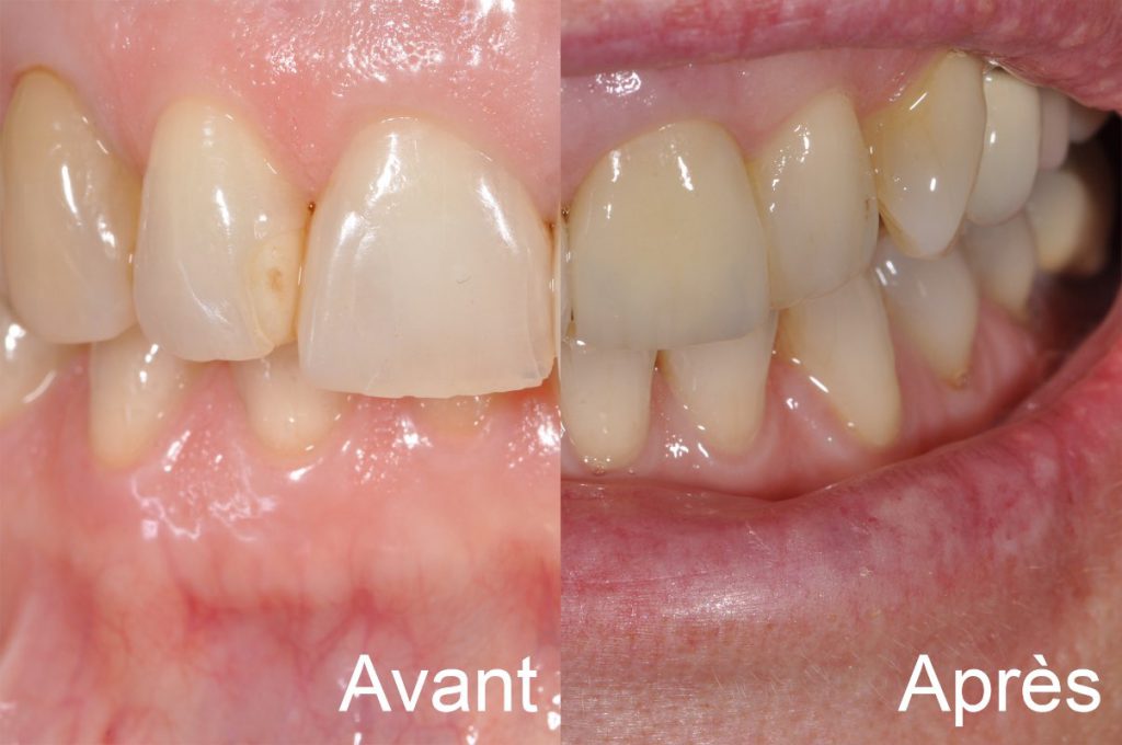 Couronne antérieure céramique - Dentiste Olivier Duc