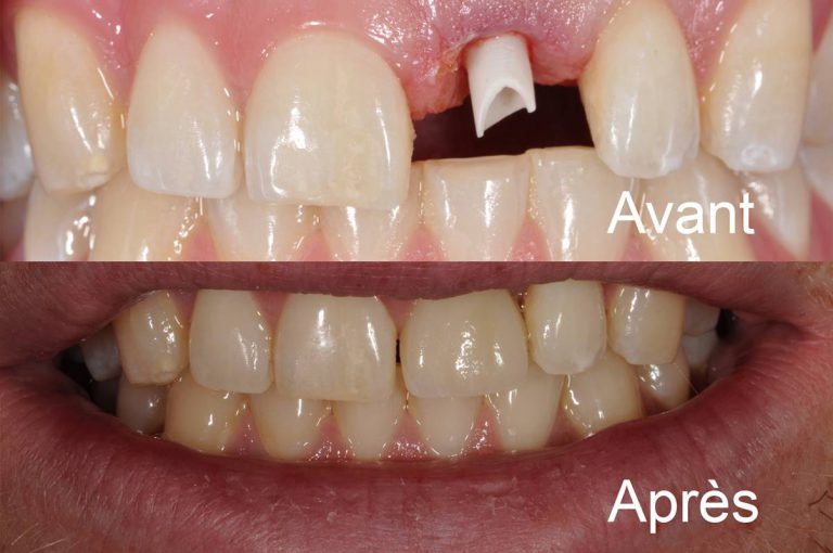 Couronne implant moignon zircone - Dentiste Olivier Duc
